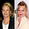 12 kjendiser som er FOR glad i botox! - Underholdning